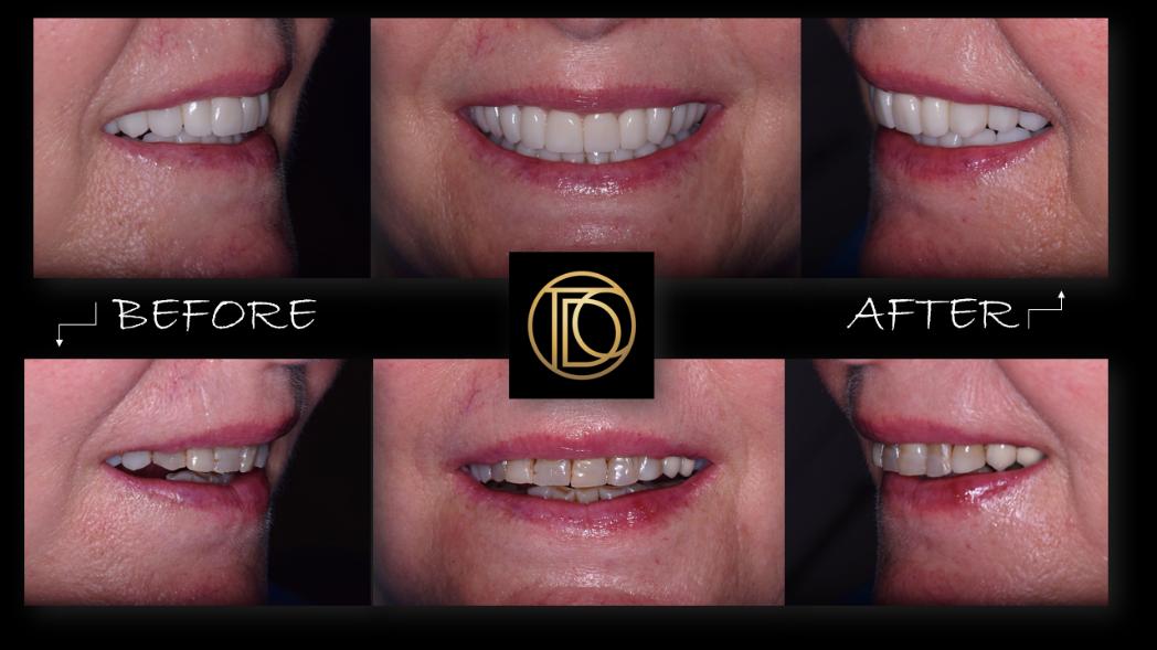 Λεύκανση δοντιών - Tachmatzidis Dental Care - Οδοντιατρείο Θεσσαλονίκη
